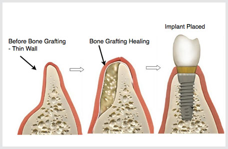 Synthetic Bone Graft | Dentistry in Oxford | SummerTown Dental & Implants